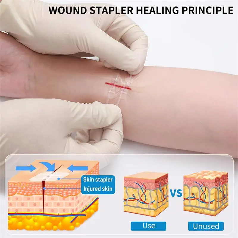 URIT 2/4/6 Pcs Zipper Band-aid Painless Wound Closure Device Suture ...
