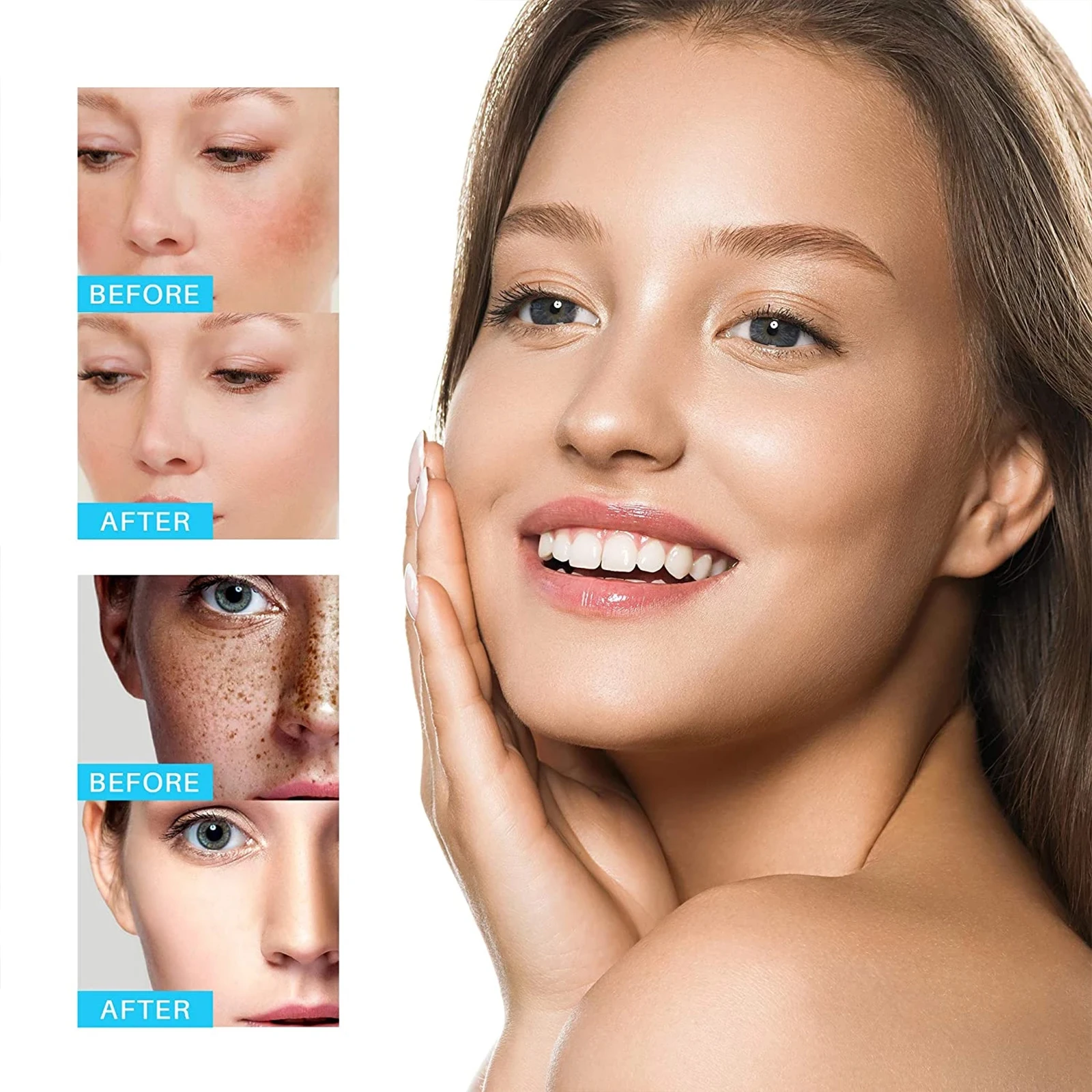 Whitening Cream Face Freckle Remove Dark Spots Fade Acne Scars Melanin ...