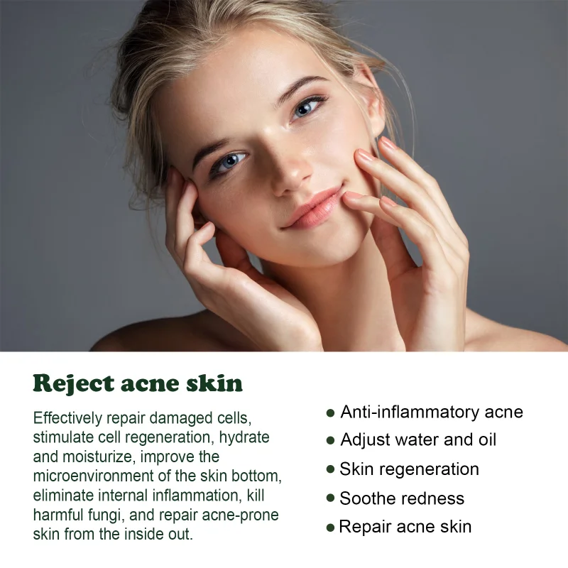 Acne Repair serum Lightens Acne Marks Scar Removes Clean Oil Control ...
