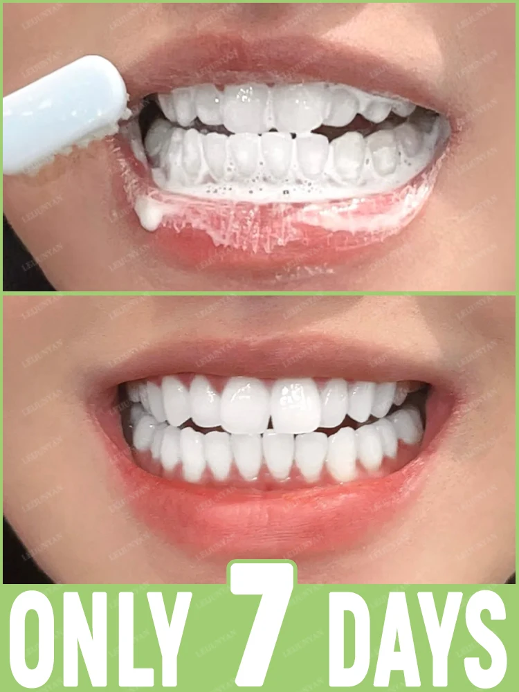 Пластырь для отбеливания зубов POZOAMIS | AliExpress