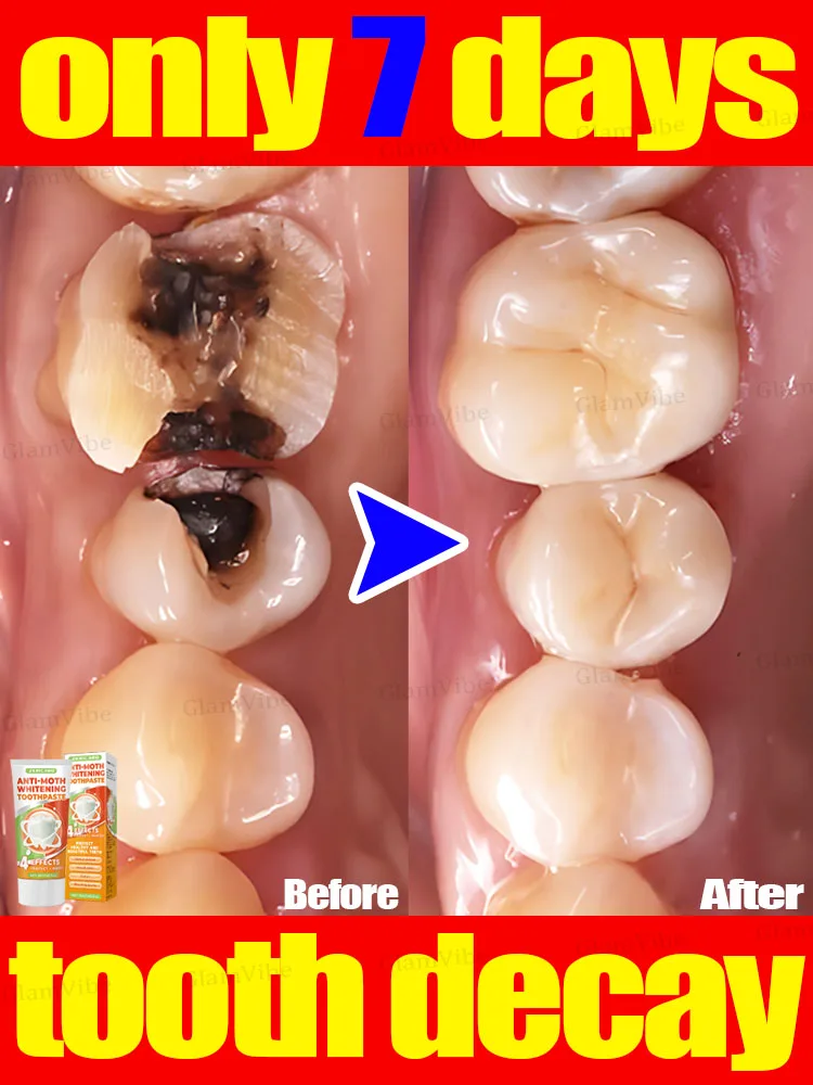 Зубная паста POZOAMIS для лечения кариеса | AliExpress