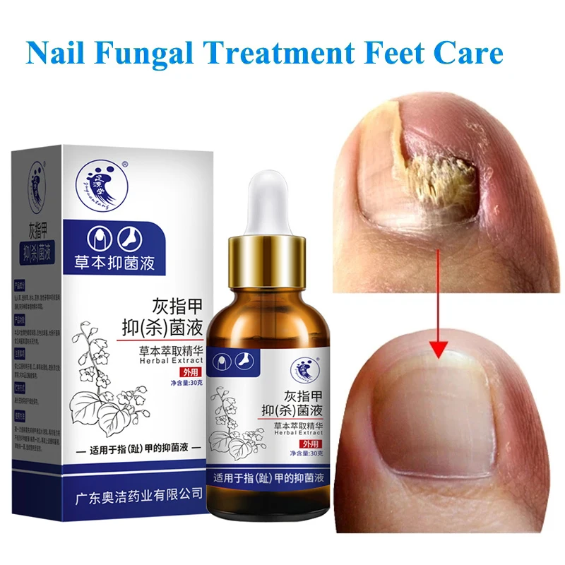Сыворотка для лечения Ногтей от грибков, онихомикоз, паронихия ...