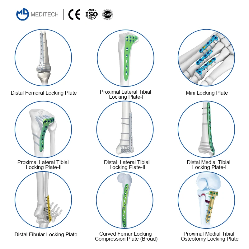 Femoral Trauma Orthopedic Implants Titanium Locking Lcp Distal Femur ...