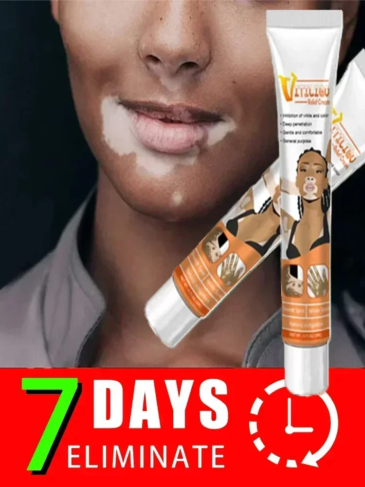 Крем для лечения Vitiligo спрей для облегчения Vitiligo лампа для лечения кожи мазь для