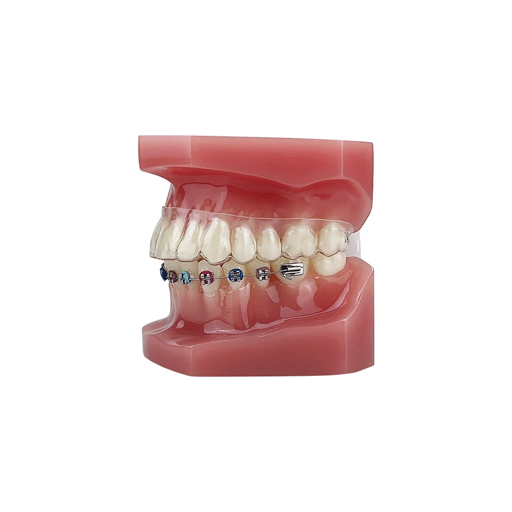 Orthodontic Models Dental Model With Braces With Ortho Metal Ceramic ...